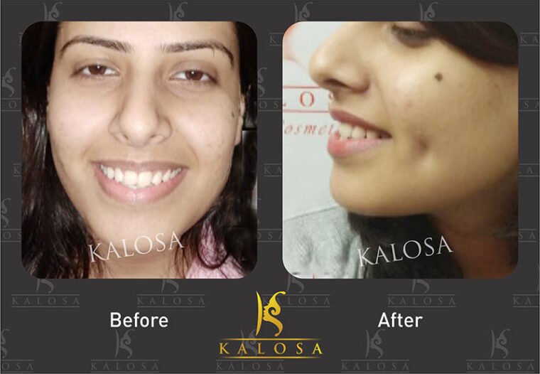 Dimple Creation Surgery Gallery | Kalosa - Plastic Surgeon Clinic